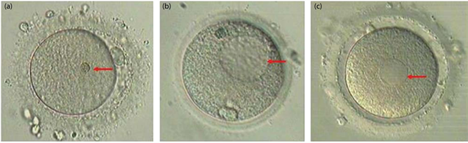 Markers of Oocyte Quality to Enhance Human IVF Outcomes: A ...