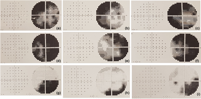 Subtenon Injection of Autologous Platelet-Rich Plasma in Retinitis ...