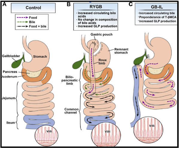Impact of Ursodeoxycholic Acid on Gall Stone Formation Post Bariatric ...