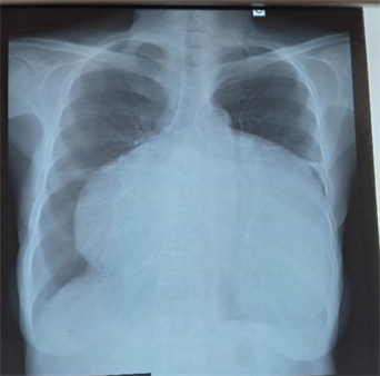 Right Heart Failure Indicative of Ebstein’s Disease in Adulthood about ...