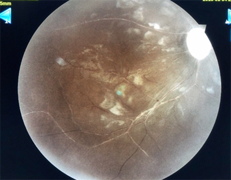 Purtscher-Like Retinopathy as First Presentation in a Newly Diagnosed ...