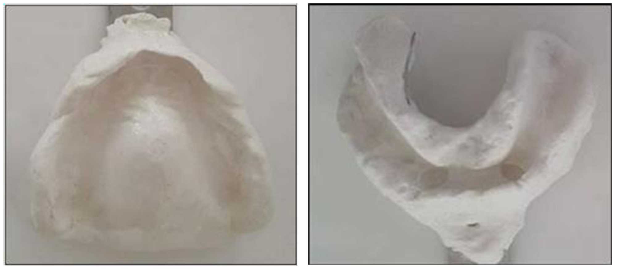 Treatment Approaches to Improve Retention and Stability of Mandibular ...