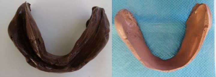 Treatment Approaches to Improve Retention and Stability of Mandibular ...