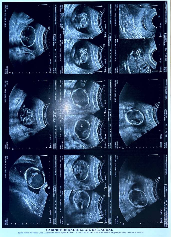 Cerebellar Agenesis: A Very Rare Abnormality of the Posterior Fossa