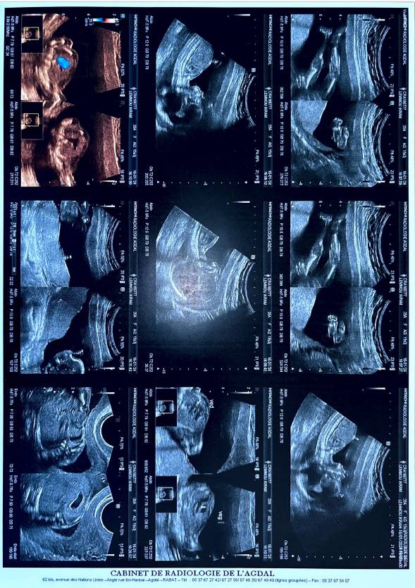 Cerebellar Agenesis: A Very Rare Abnormality of the Posterior Fossa