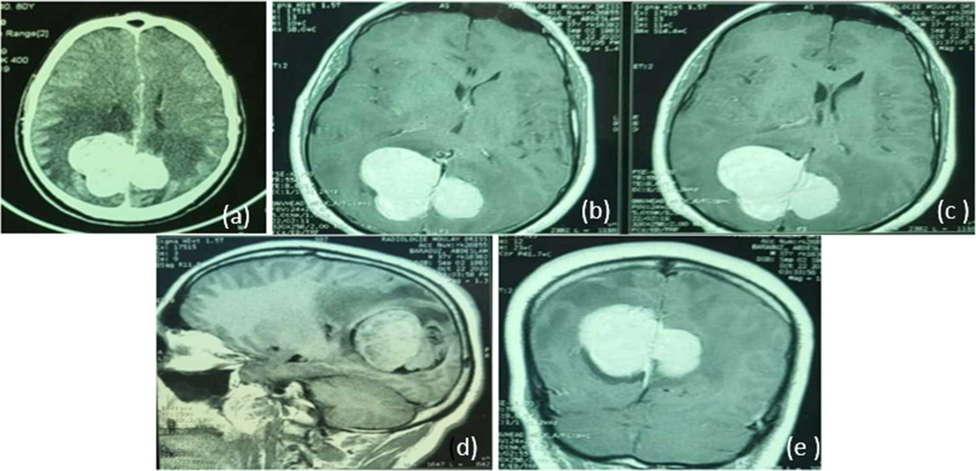 Hemangiopericytoma of the Falx Cerebri: A Rare Intracranial Tumor: A ...