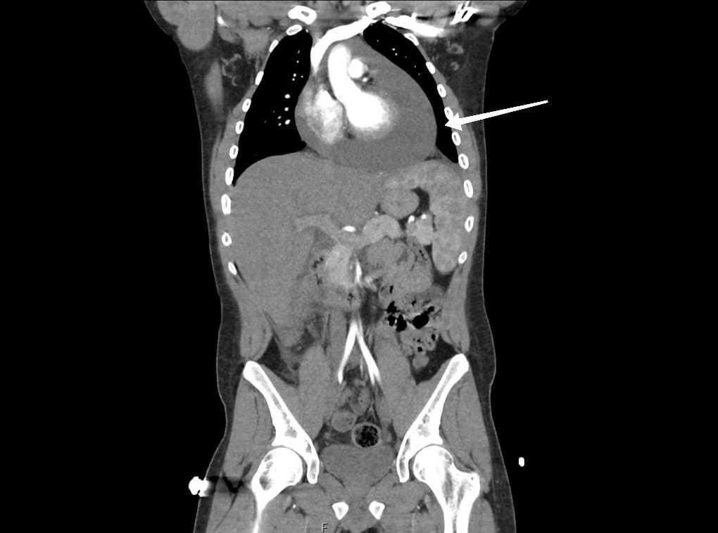 Hemorrhagic Pericardial Cyst Mimicking Pleural Effusion