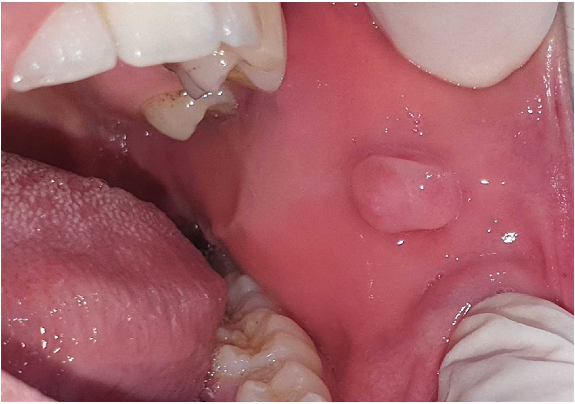 A Comprehensive Guide to Diagnosing Oral Mucosal Lesions: Part I ...