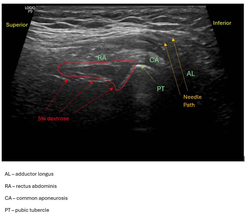 Ultrasound-Guided Athletic Pubalgia Prolotherapy: A Novel Treatment