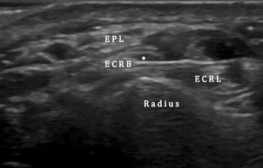 Ultrasound-Guided Hydro Dissection: A Novel Treatment Approach for ...