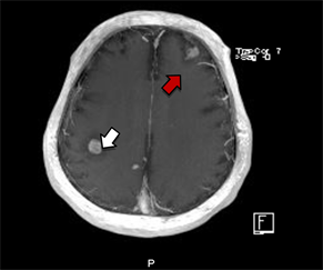 Neurocisticercose