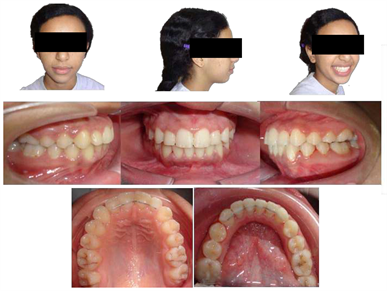 Management of Class II Malocclusion in Children and Adolescents: A Case ...