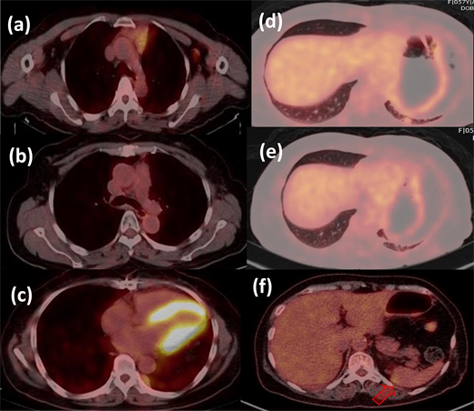 Recurrent Thymoma with Lung, Pleural, and Splenic Metastases Demonstrated on F-18 FDG PET/CT