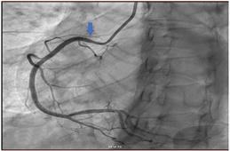 Thyrotoxicosis Related Coronary Artery Spasm Presenting as Acute ...