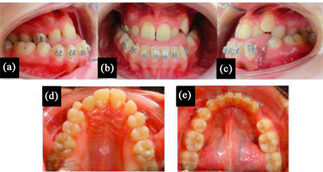 Maxillary Transverse Expansion: What Are the Limits? A Case Report and ...