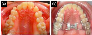Maxillary Transverse Expansion: What Are the Limits? A Case Report and ...