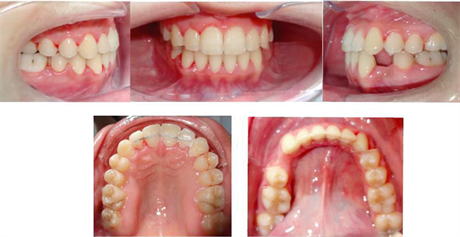 Maxillary Transverse Expansion: What Are the Limits? A Case Report and ...