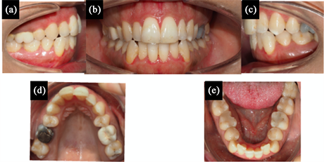 Maxillary Transverse Expansion: What Are the Limits? A Case Report and ...