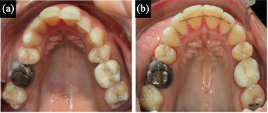 Maxillary Transverse Expansion: What Are the Limits? A Case Report and ...