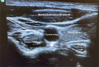 Observation of the Therapeutic Effect of Ultrasound-Guided Stellate ...