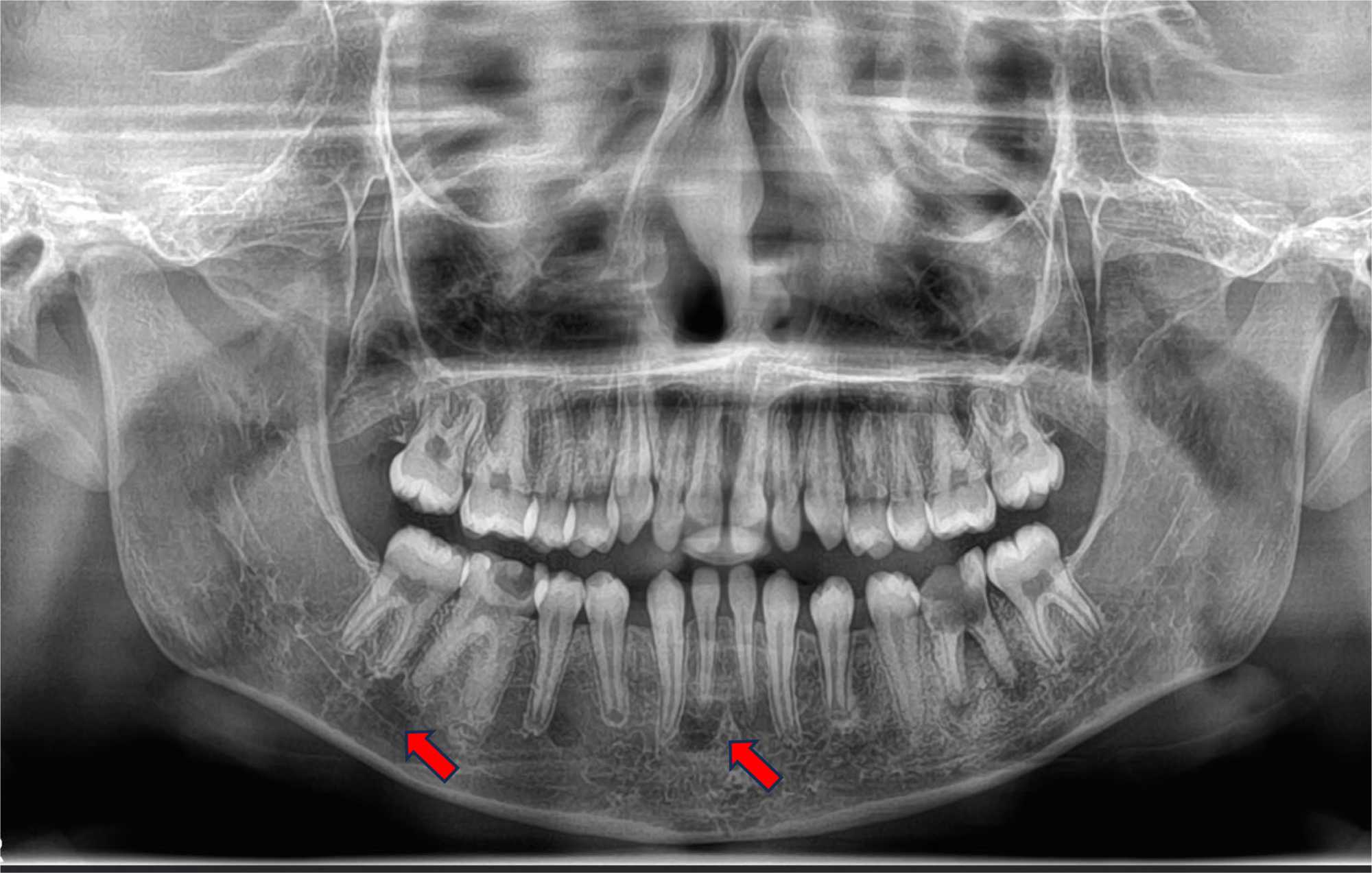 Bone Changes in the Mandible: A Radiographic Study of a Paediatric ...