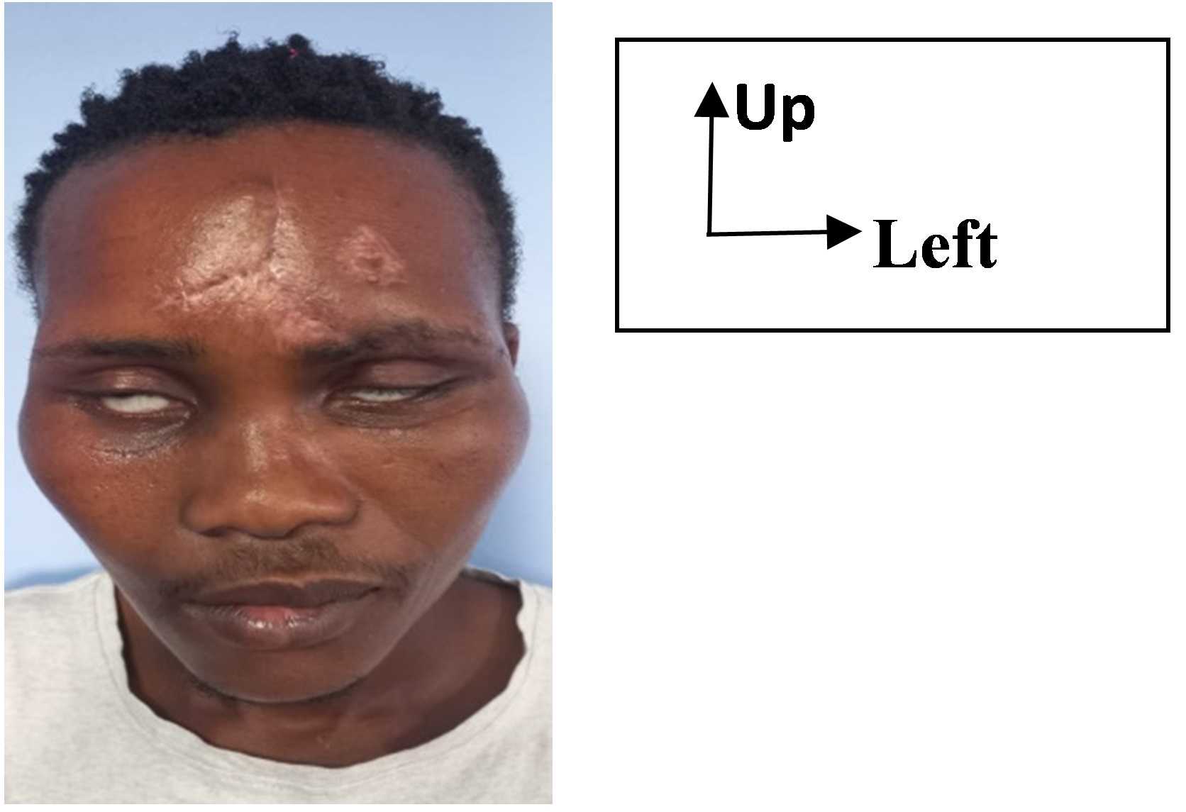 Facial Diplegia Secondary to Cranio-Maxillo-Facial Trauma: About a Case ...