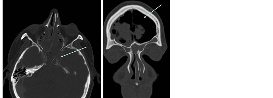 Endocranial Complications of Endoscopic Sinus Surgery: Learning from ...