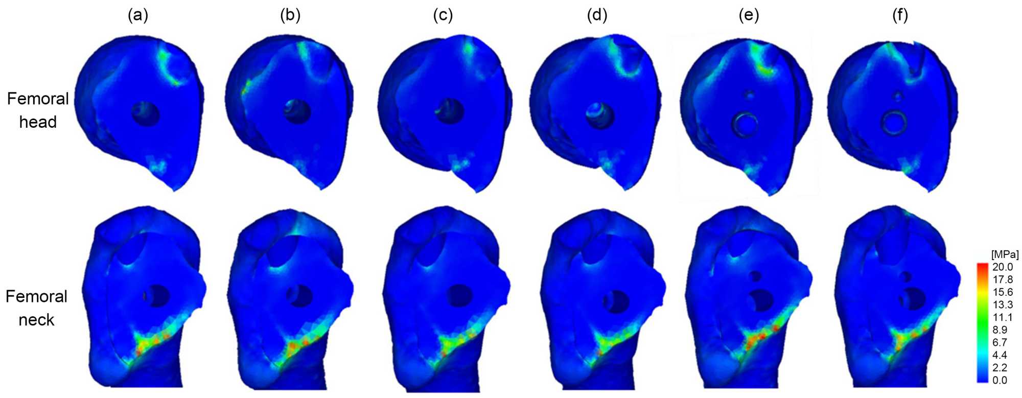 Finite Element Analysis of Coronal Shear Fractures of the Femoral Neck ...