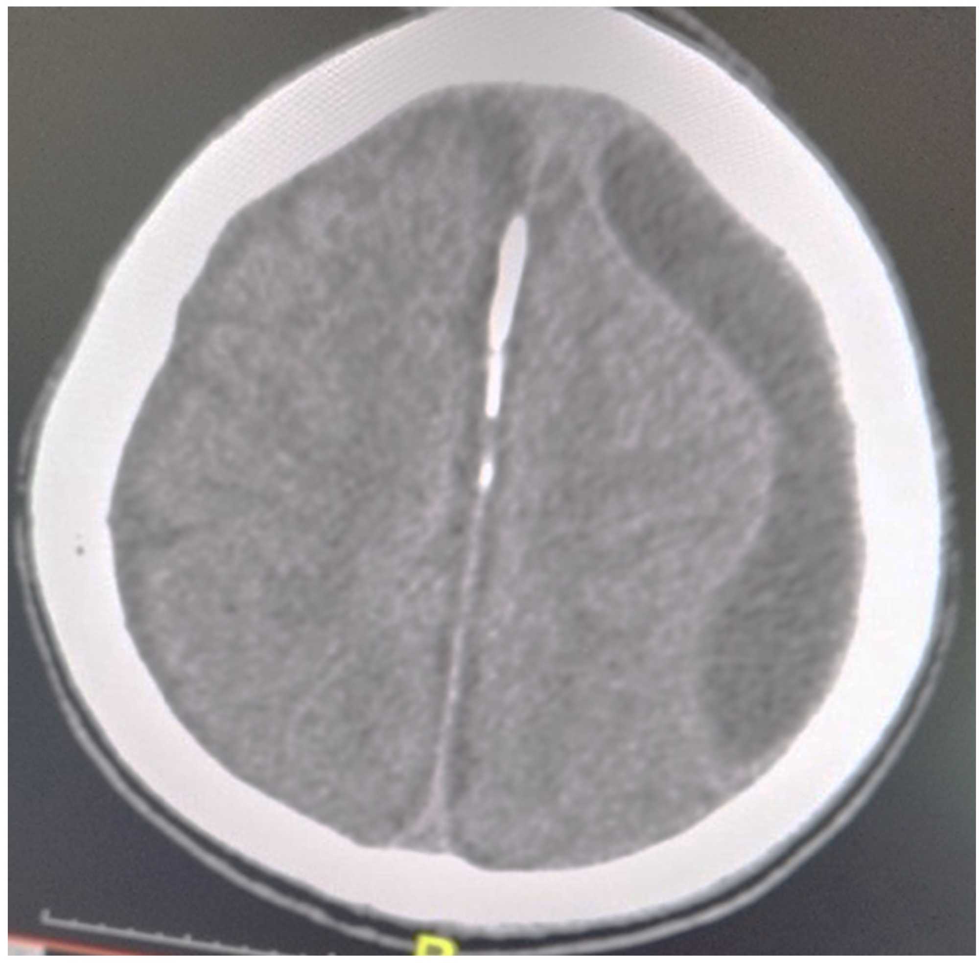 Contribution of CT Scanning in the Investigation of Cranioencephalic ...