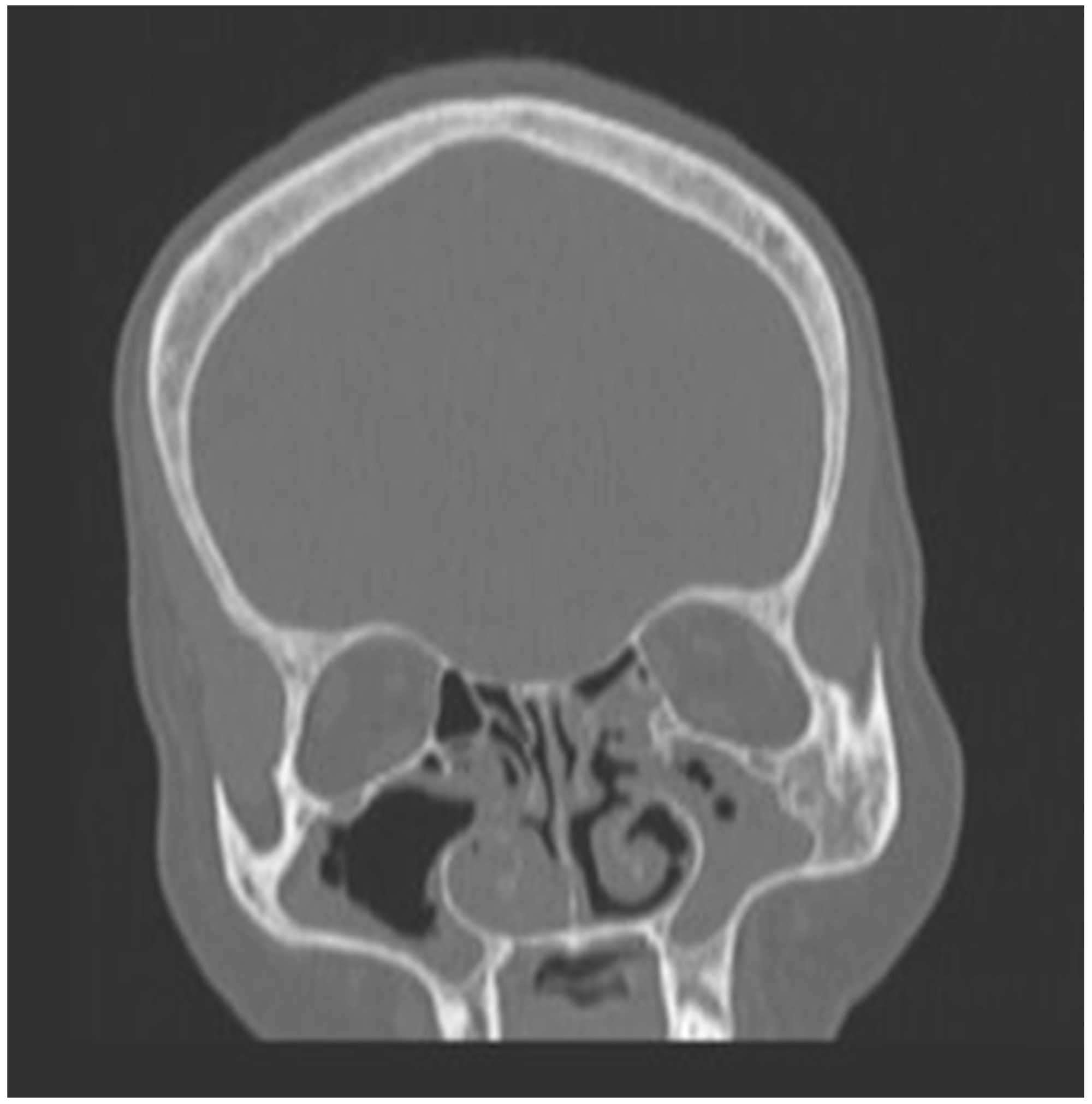 Contribution of CT Scanning in the Investigation of Cranioencephalic ...