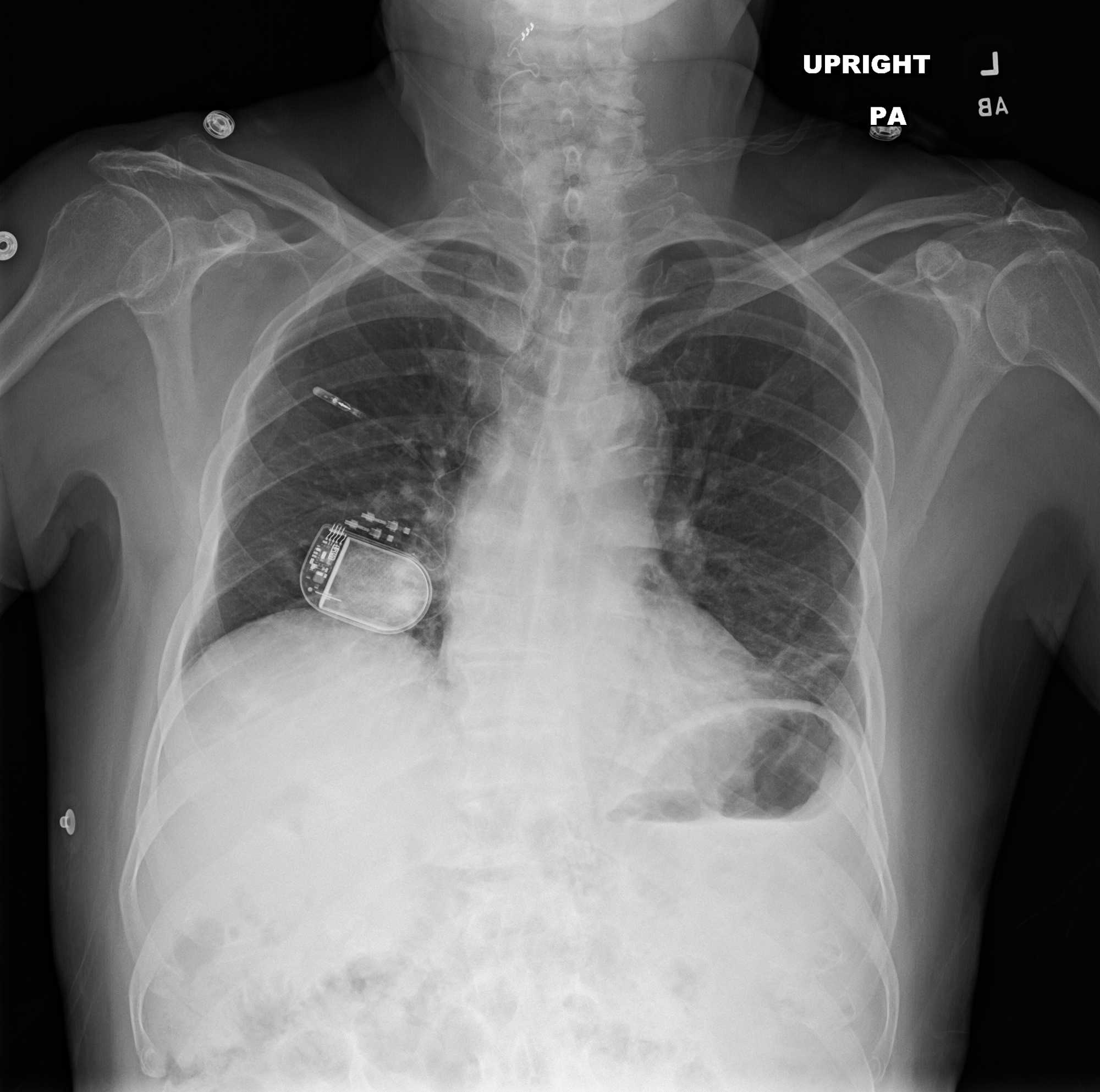 Post-Surgical Chest and Neck Radiographs to Confirm the Successful ...