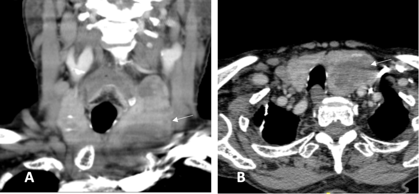 Thyroid Artery Embolization as an Alternative Treatment for Symptomatic ...
