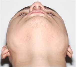 Surgical treatment of bilateral temporalis and masseteric hypertrophy ...