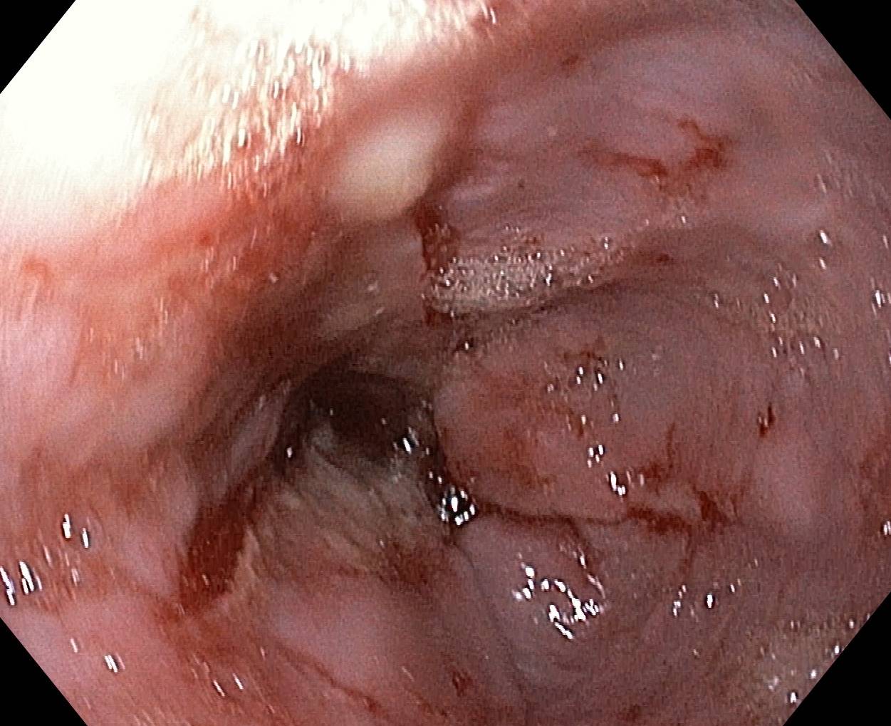 A Rare Case of Herpetic Esophagitis in an Immunocompetent Patient with ...