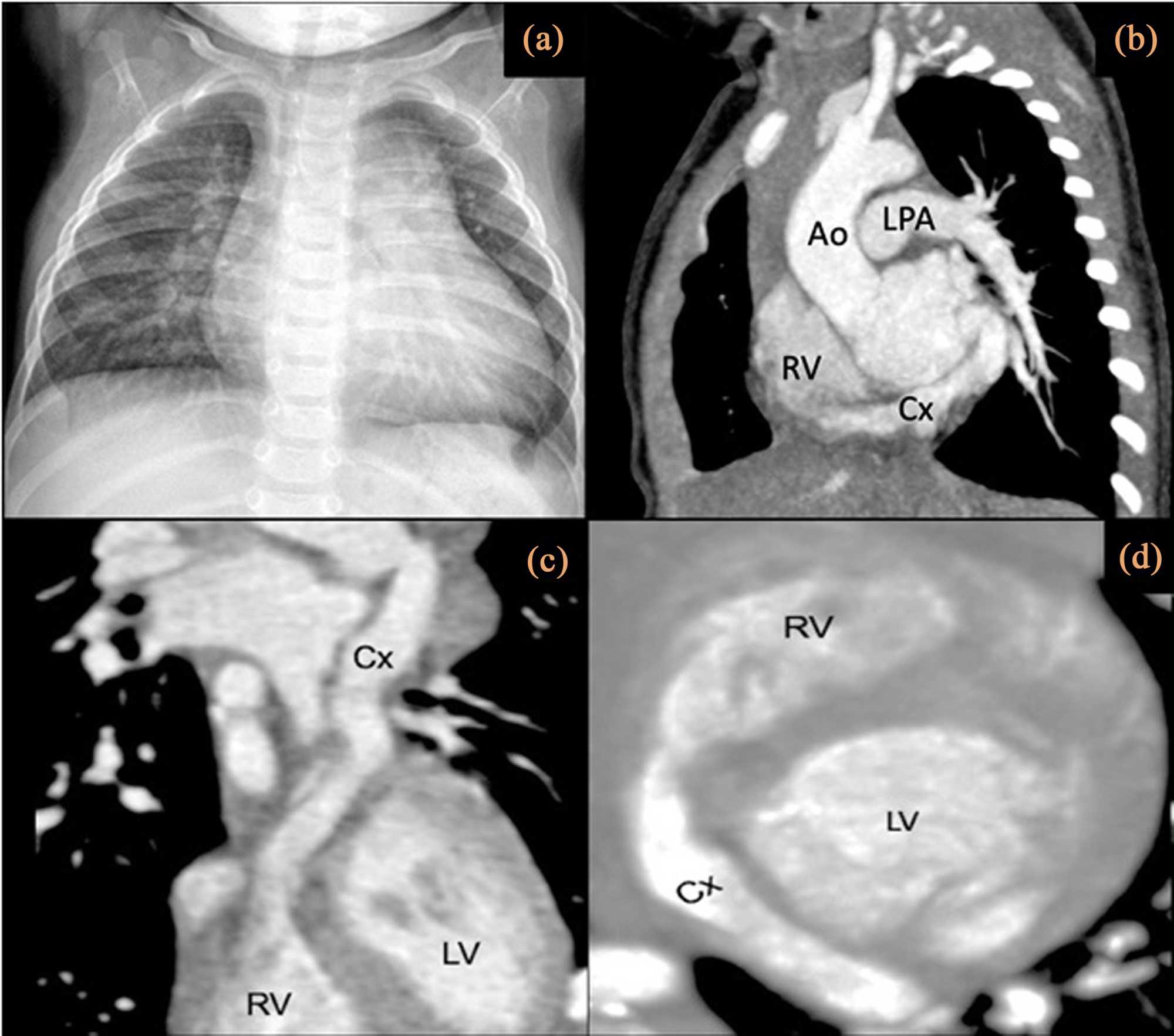 Occlusion with a Vascular Plug of a Congenital Circumflex Coronary ...