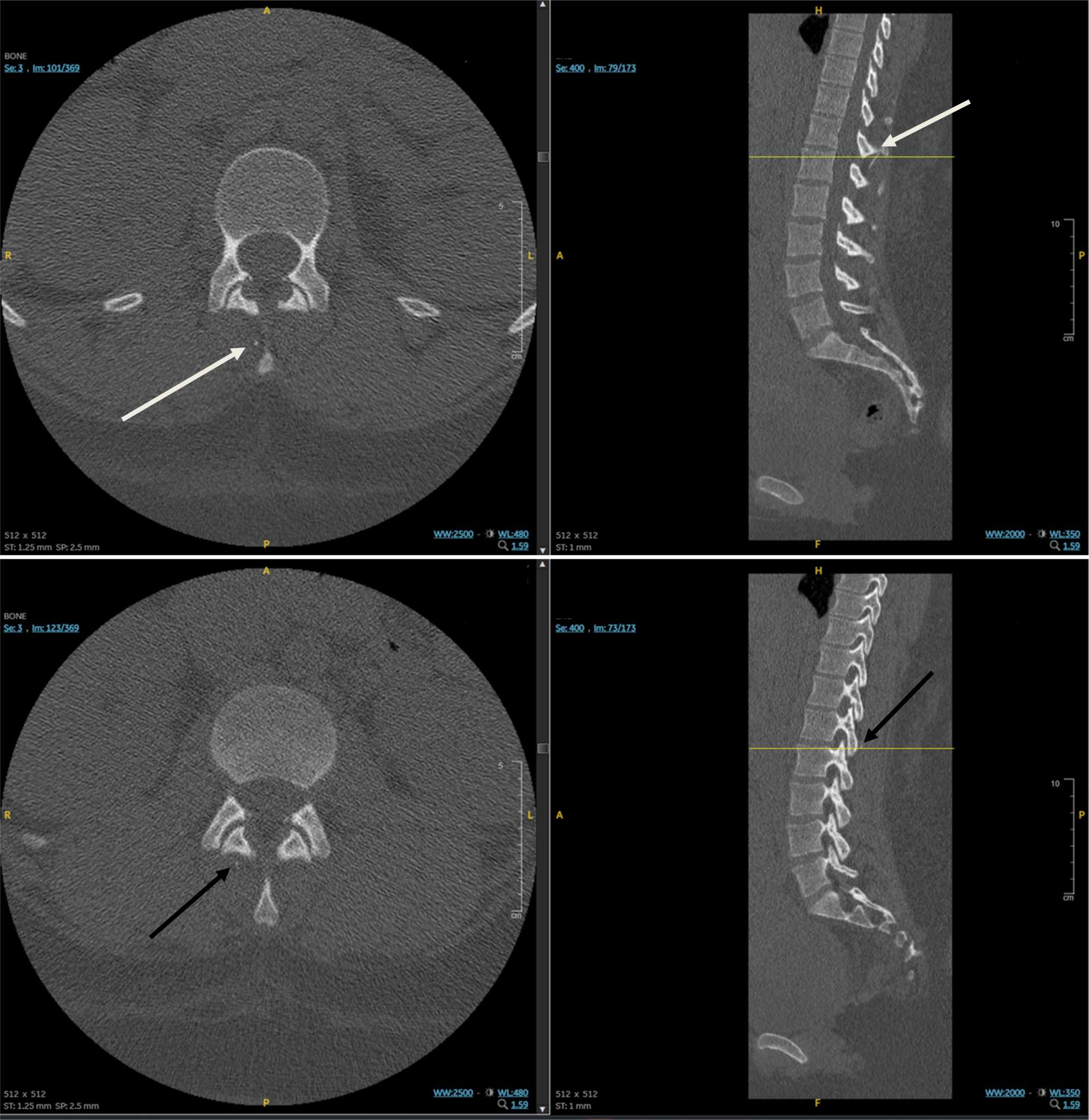 Management of a Retained Epidural Catheter in a Pregnant Patient: A ...