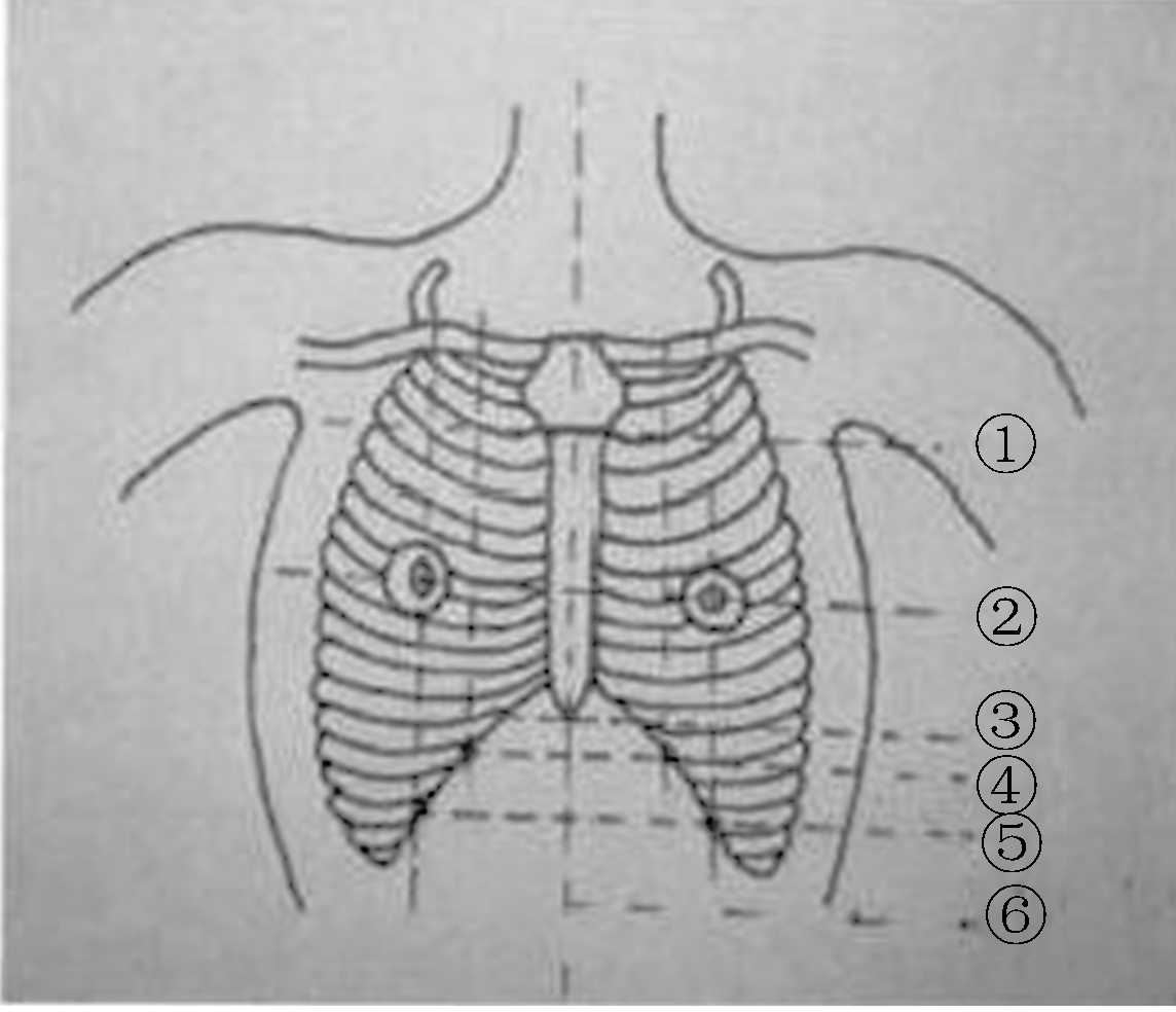 Donor-Site Morbidity Following Harvest of Autologous Costal Cartilage ...