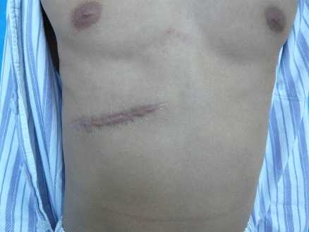 Donor-Site Morbidity Following Harvest of Autologous Costal Cartilage ...