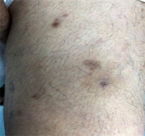 Urticarial Bullous Pemphigoid: A New Case Report