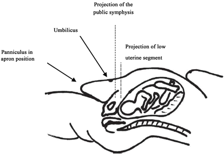 Supraumbilical Transverse Incision for Cesarean Section in Severely ...