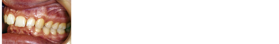 A Therapeutic Concept by “Watted” for the Surgical Lengthening of the ...