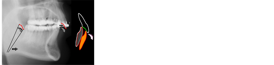 A Therapeutic Concept by “Watted” for the Surgical Lengthening of the ...