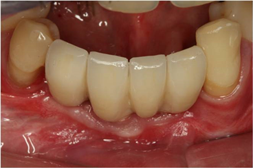 Implantosuported Rehabilitation after Marginal Recession of Mandibular ...