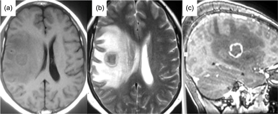 Magnetic Resonance Imaging of Central Nervous System Lesions in HIV ...