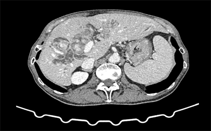 Imaging Modalities for Diagnosing Hepatolithiasis: A Case Report of ...