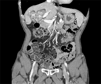 Imaging Modalities for Diagnosing Hepatolithiasis: A Case Report of ...