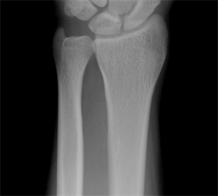 Anisotropy of Trabecular Bone from Ultra-Distal Radius Digital X-Ray ...