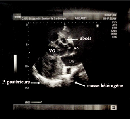 Peri-Annular and Septal Abscesses in Infectious Endocarditis. About 3 ...