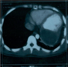 Peri-Annular and Septal Abscesses in Infectious Endocarditis. About 3 ...