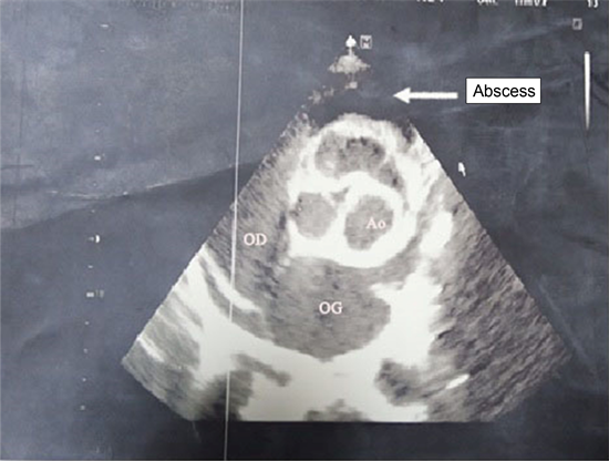 Peri-Annular and Septal Abscesses in Infectious Endocarditis. About 3 ...